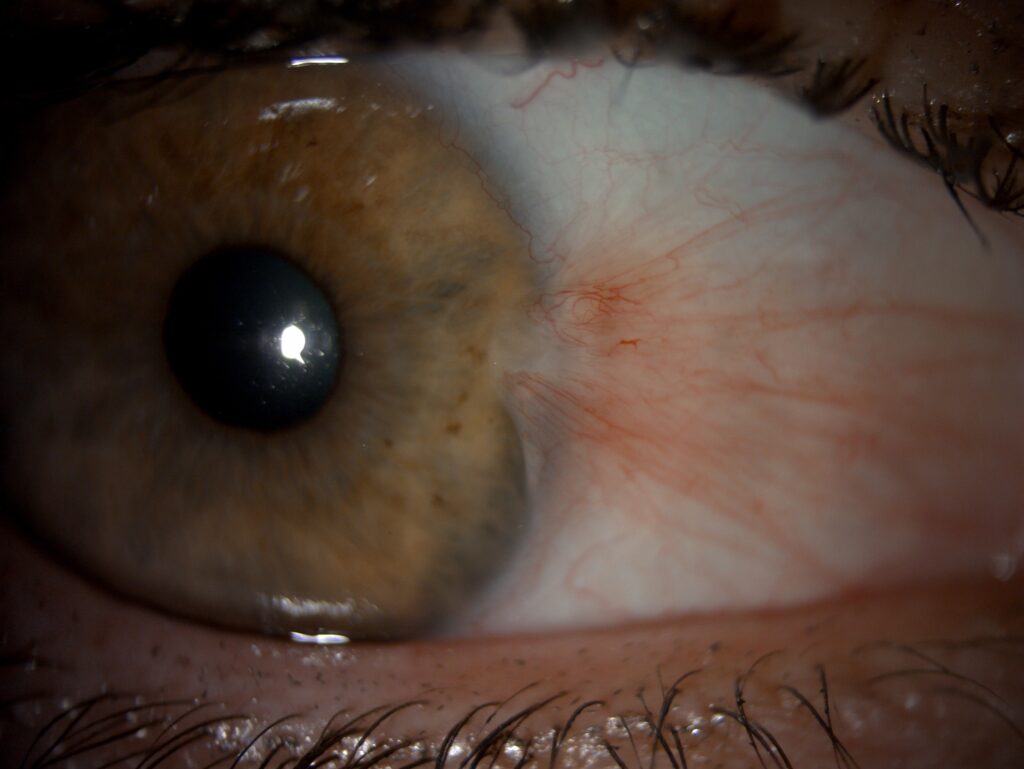 Pterygia: “Surfer’s eye” | Beckenham Optometrist Avalon NSW